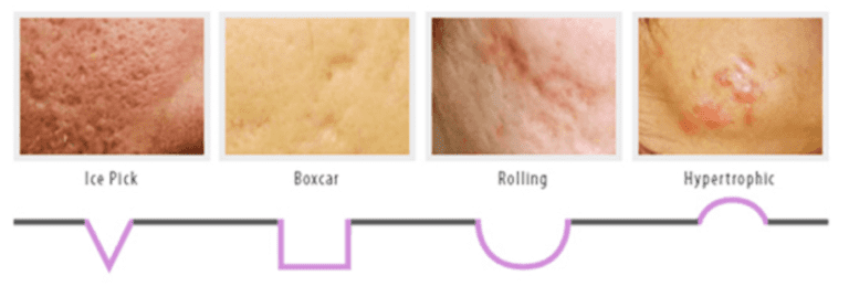 Cicatriz de acne - Dra. Fernanda de Castro